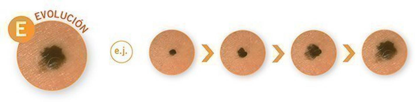 ¿Cómo identificar si un lunar es cancerígeno? | La Nación