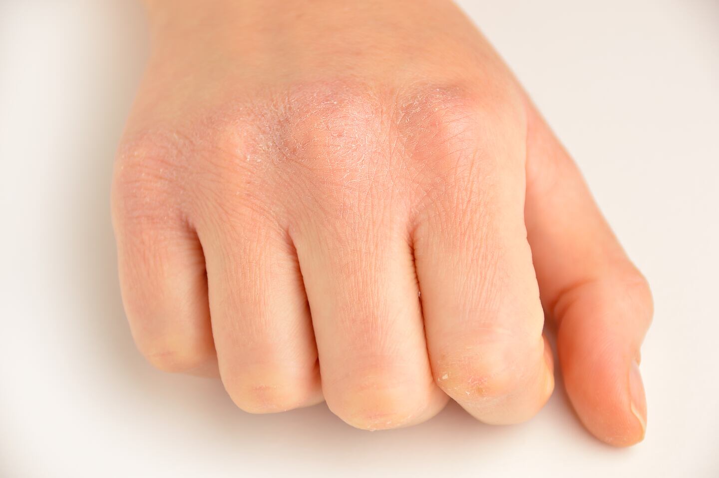 Coronavirus: ¿Cómo evitar dermatitis o piel irritada por el lavado ...