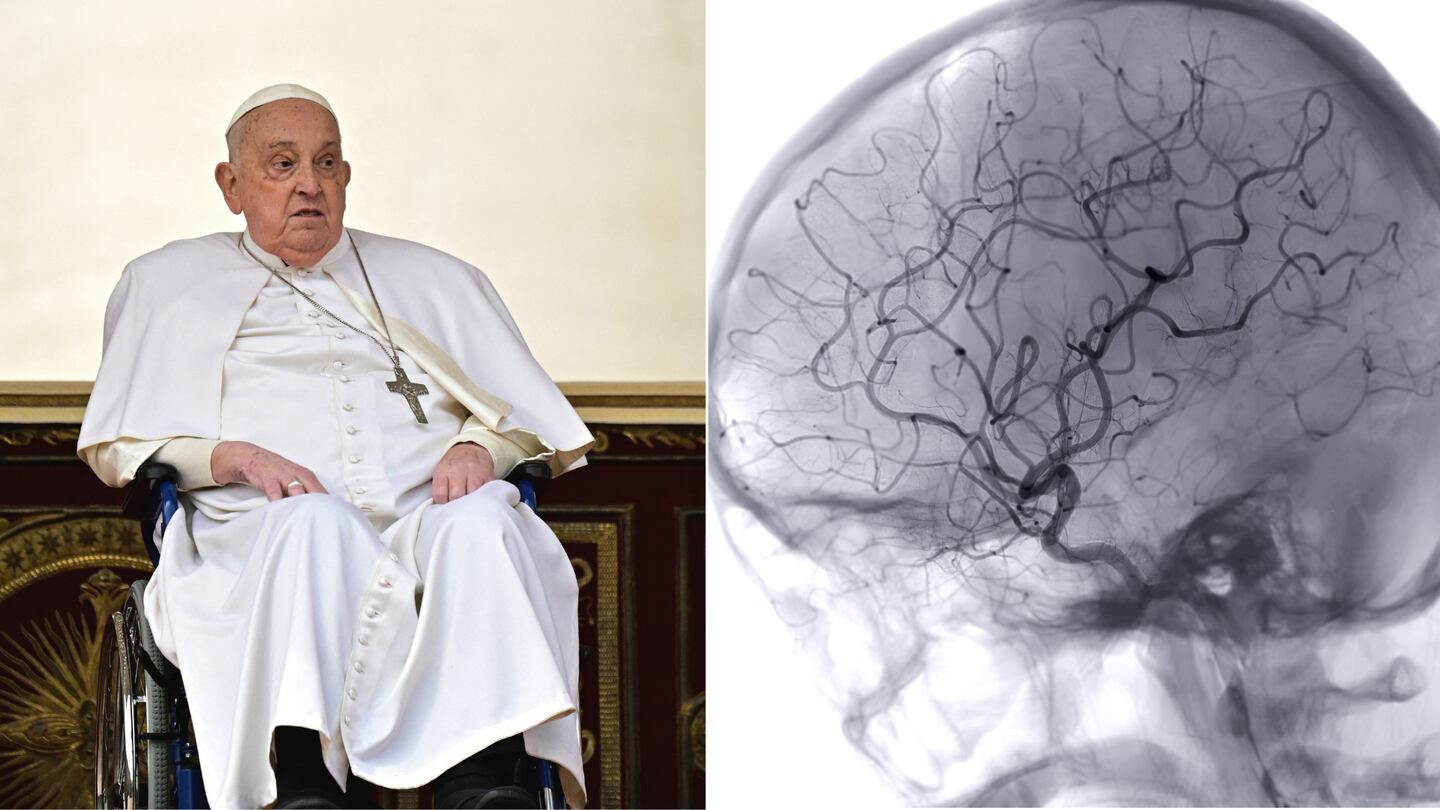 ¿Qué es ictus cerebral? La causa del fallecimiento del papa Francisco ...