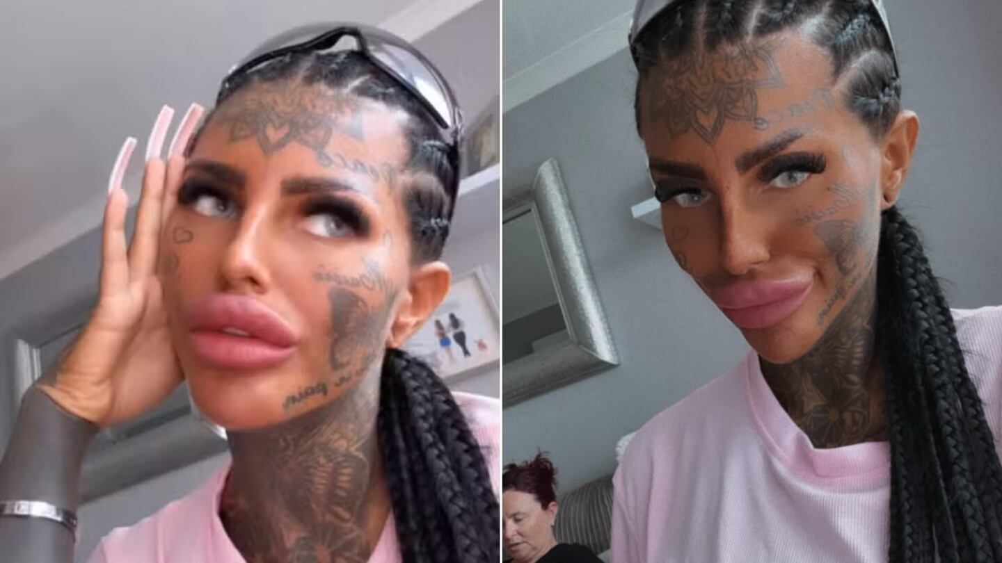 Influencer se vuelve viral al mostrar cómo el relleno de sus labios ...