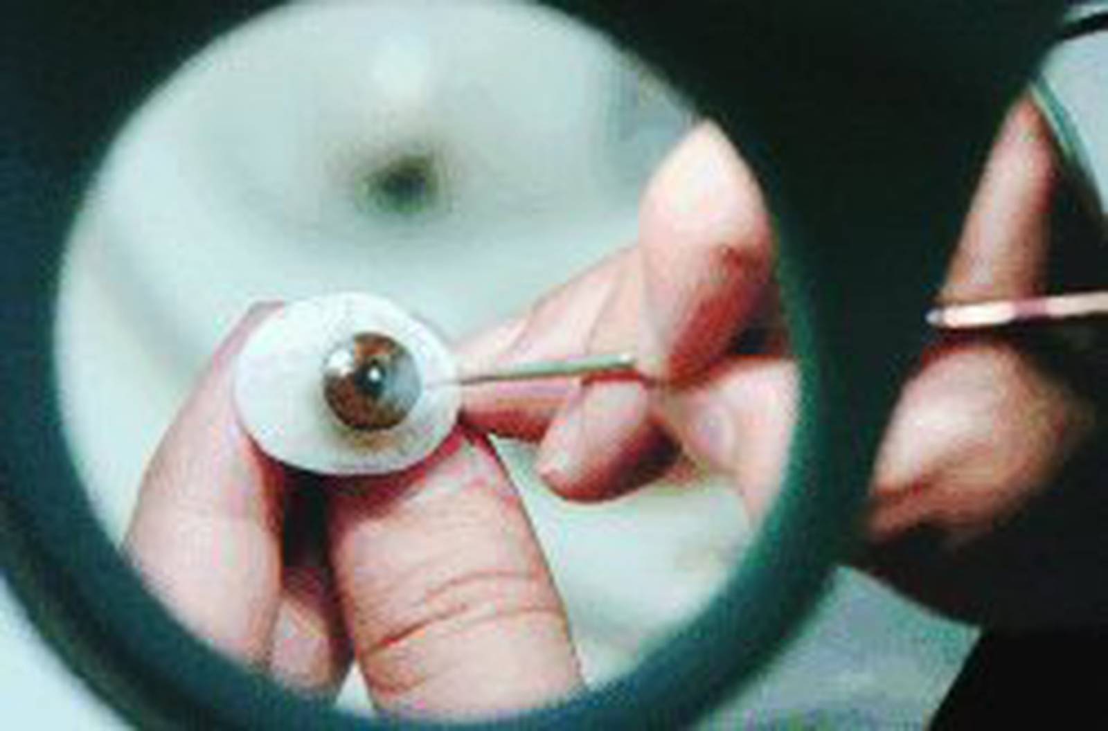 Nueva técnica da a prótesis ocular mayor movilidad | La Nación